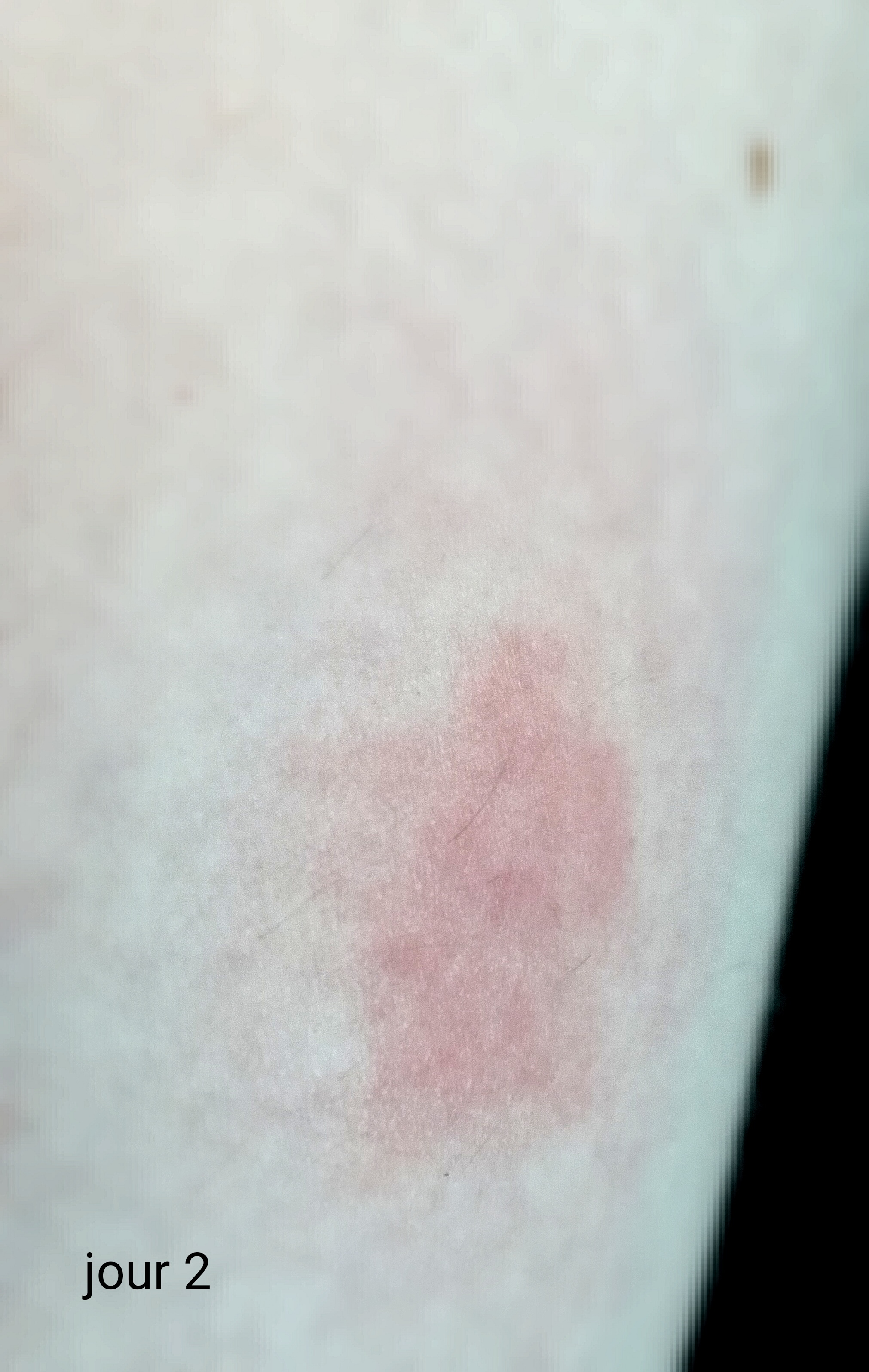 "gonflement" et rougeur suite à piqûre d'insecte - Allergies et eczéma ...